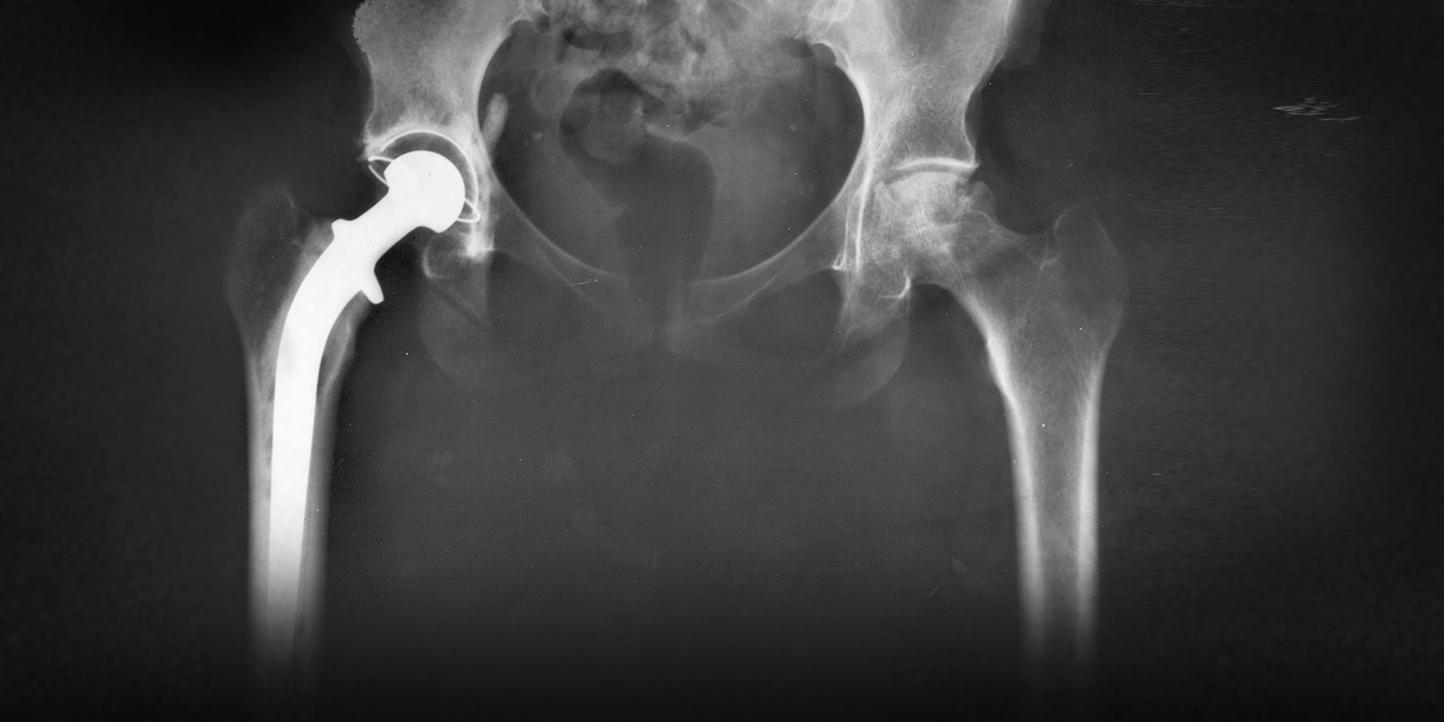 Biomet and DePuy ASR Settlements - The Miller Firm